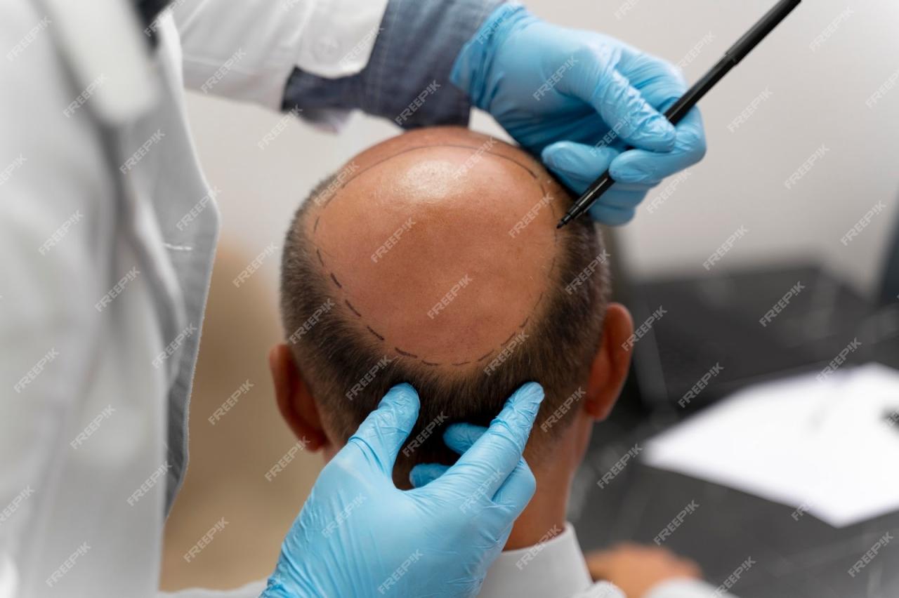 Hair Transplant: Solusi Permanen Atasi Kebotakan - Dermalight Aesthetic ...
